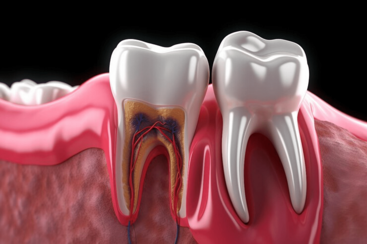 Root Canal Pain: Causes & Management